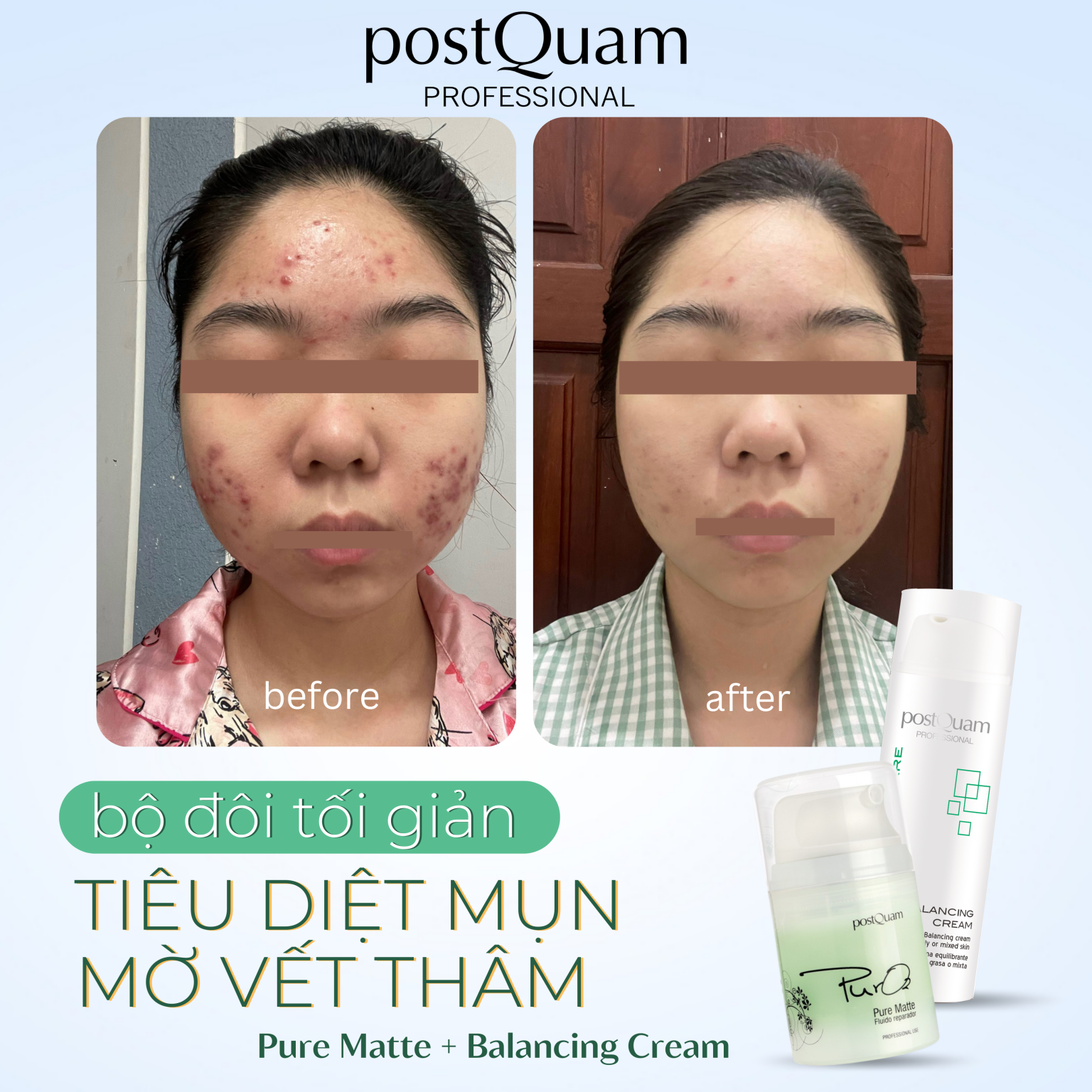 TOP 5 KEM DƯỠNG ẨM CHO DA DẦU MỤN TỐT NHẤT 2022 BẠN NÊN THỬ